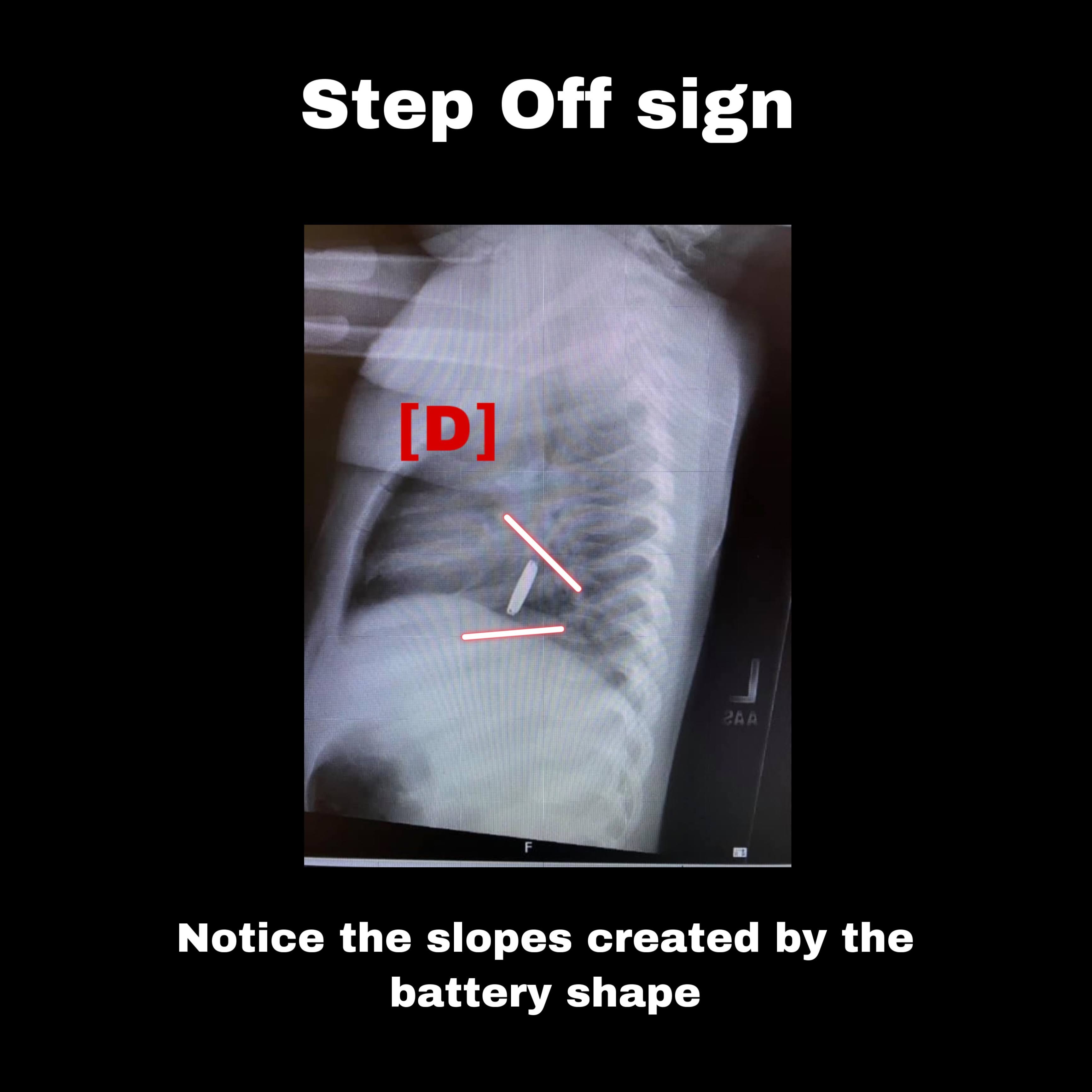 Information for Medical Providers – Button Battery Awareness