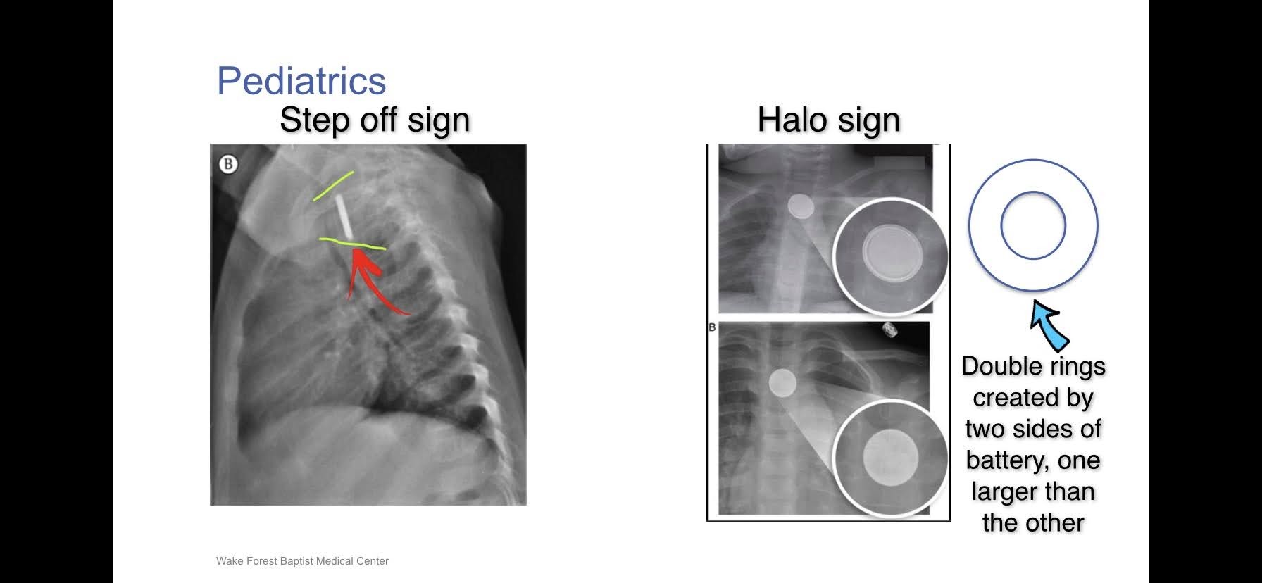 Information for Medical Providers – Button Battery Awareness